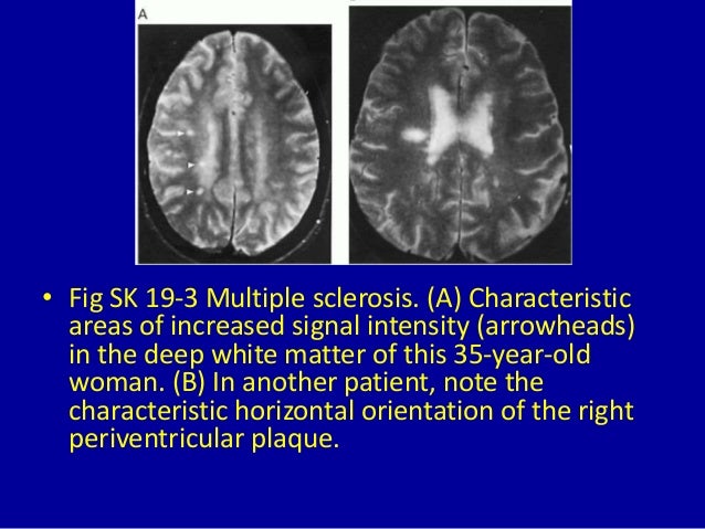 19 periventricular white matter abnormalities on magnetic resonance
