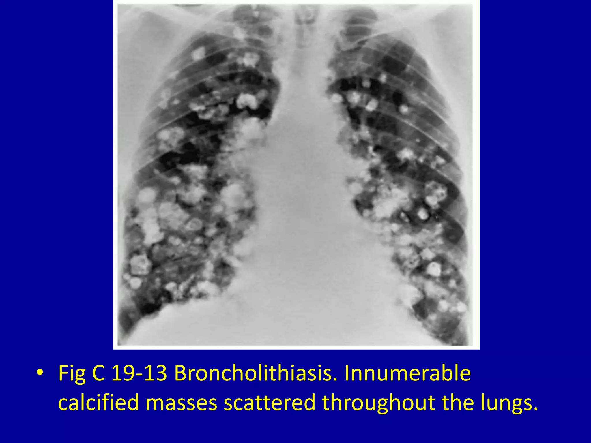 19 pulmonary parenchymal calcification | PPTX