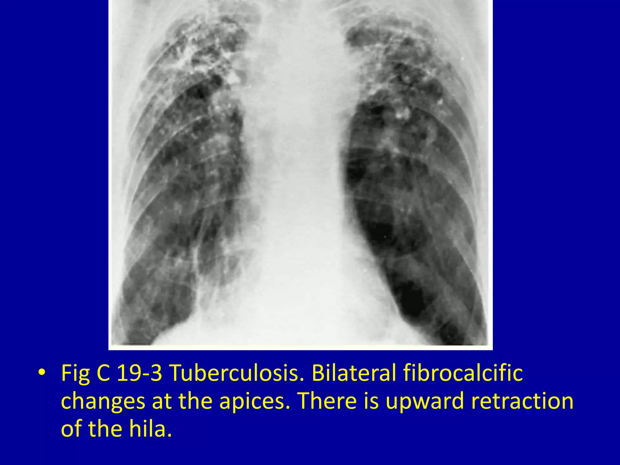 19 pulmonary parenchymal calcification | PPTX