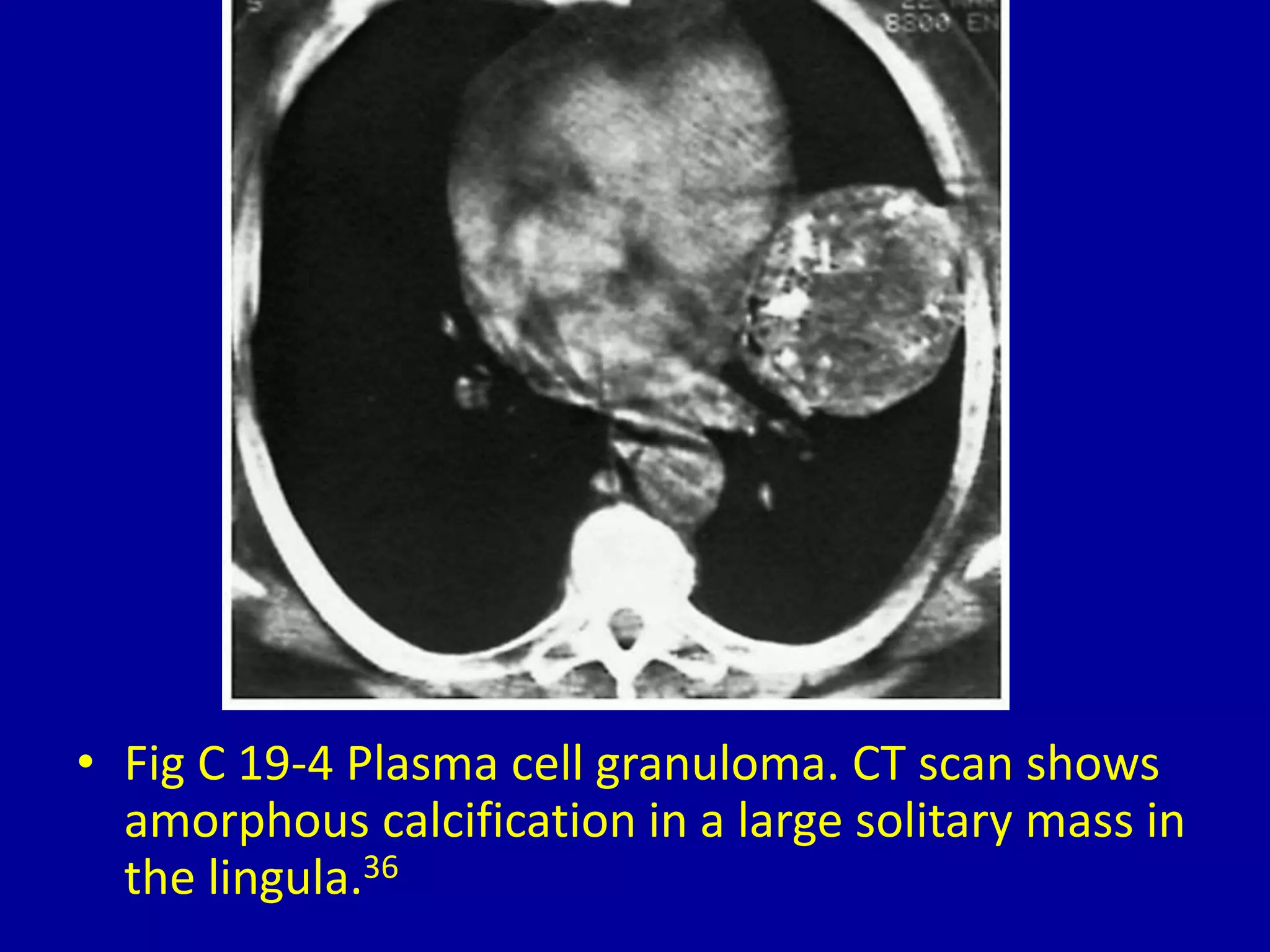 19 pulmonary parenchymal calcification | PPTX