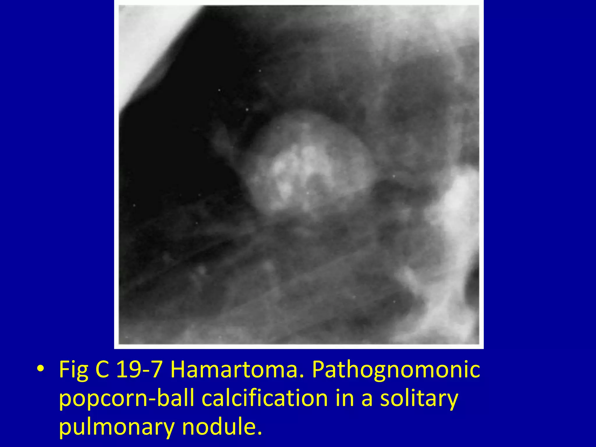 19 pulmonary parenchymal calcification | PPTX