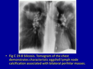19 pulmonary parenchymal calcification | PPTX