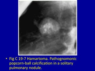 19 pulmonary parenchymal calcification | PPTX