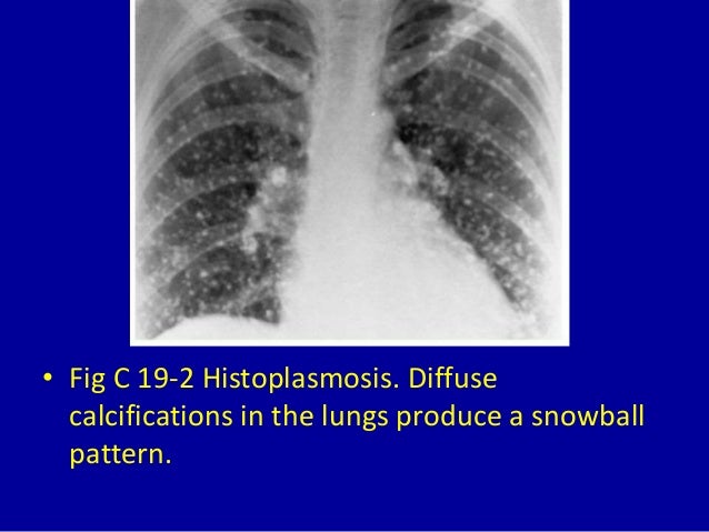 19 pulmonary parenchymal calcification