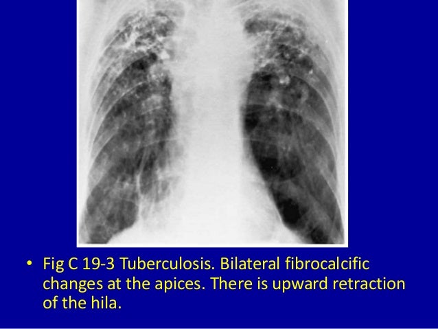19 pulmonary parenchymal calcification