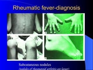 Rheumatic fever & acute rheumatic heart disease Rheumatic fever & acute ...