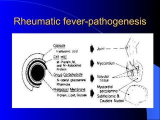 Rheumatic Fever Pathogenesis