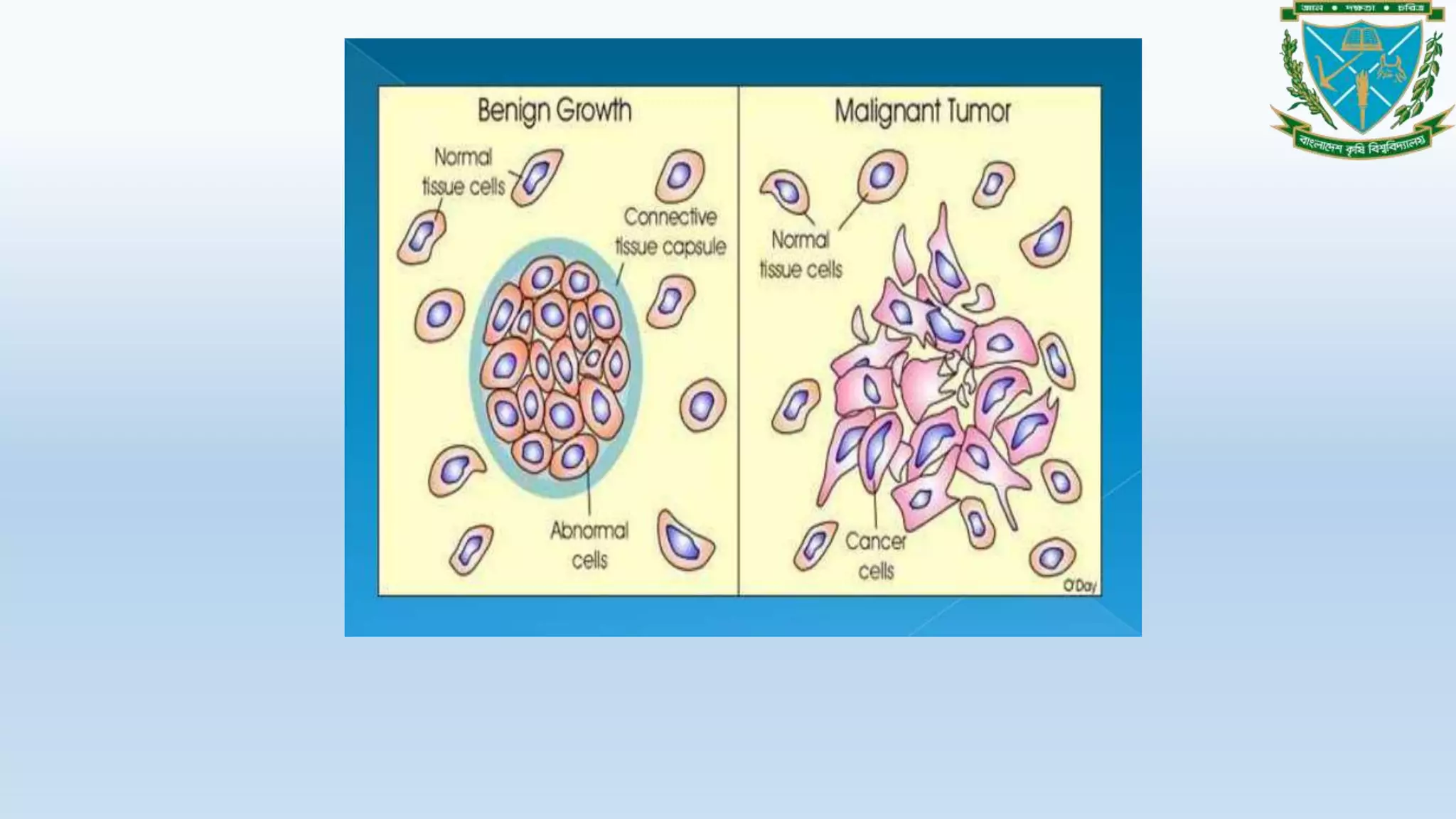Tumor of the skin-types, general features of Benign and Malignant tumor ...