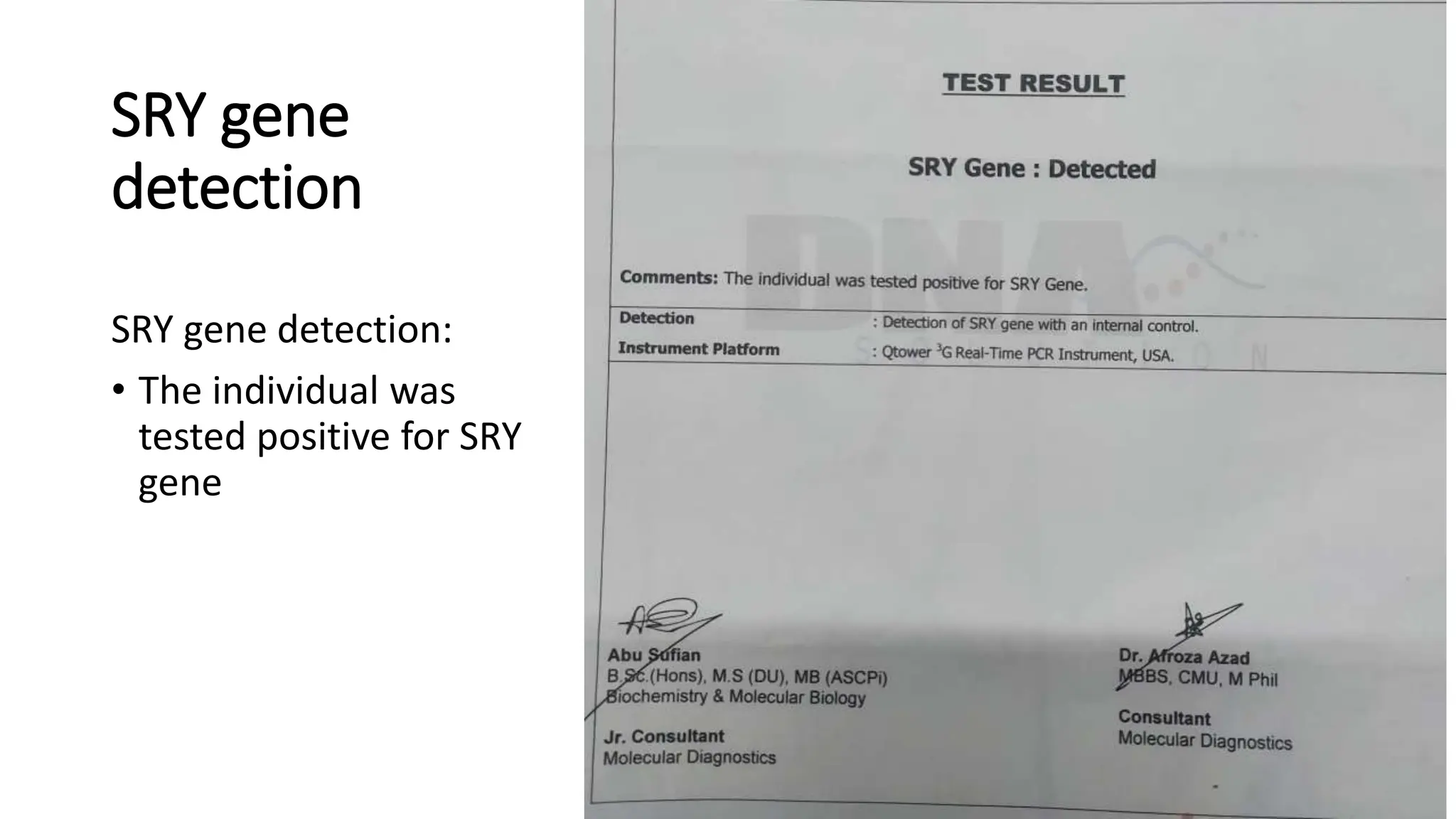 Turners Syndrome (Mixed gonadal dysgenesis).pptx