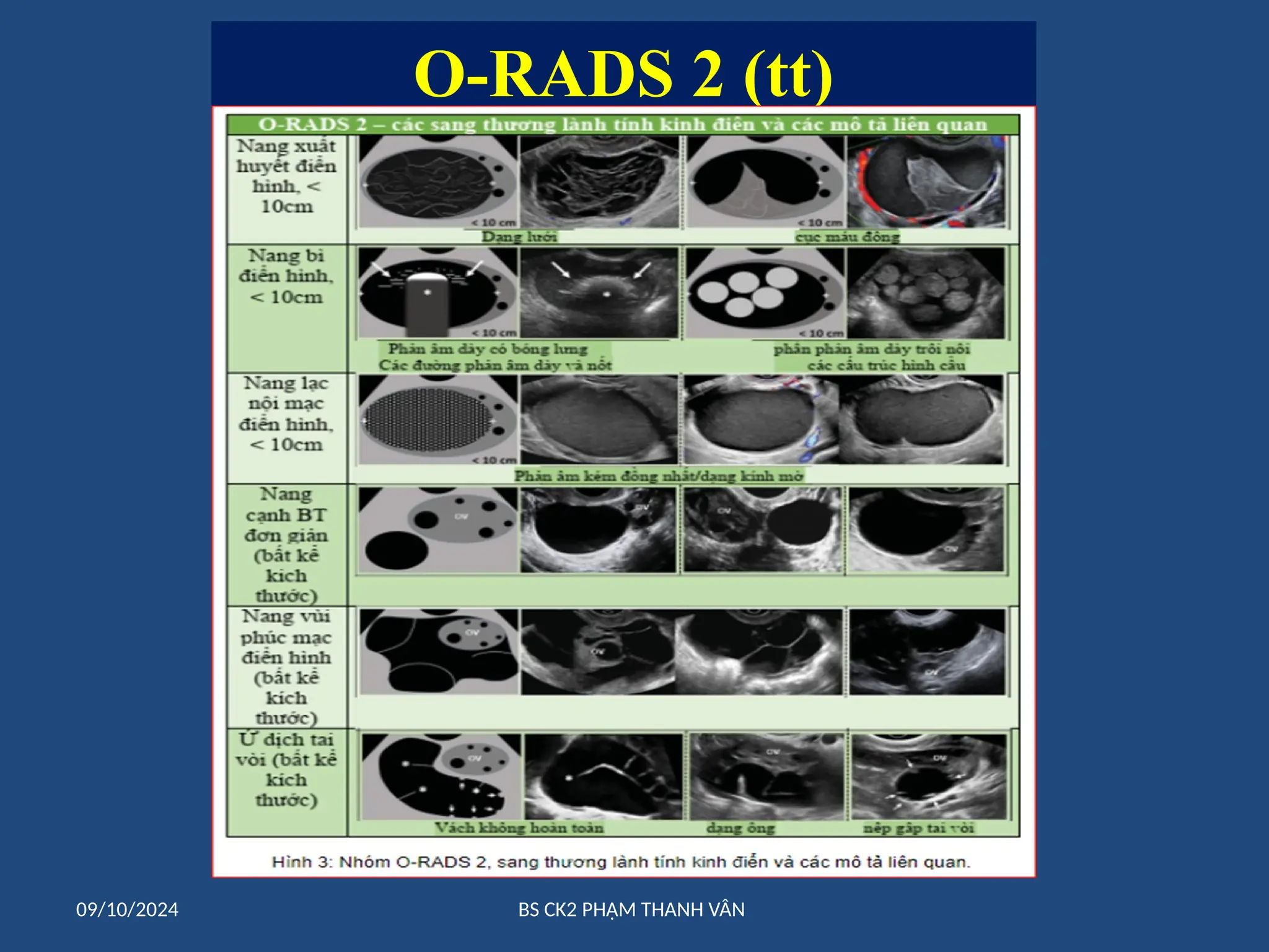 O-RADS 27-12-2023 Phan tang u buong trung.pptx