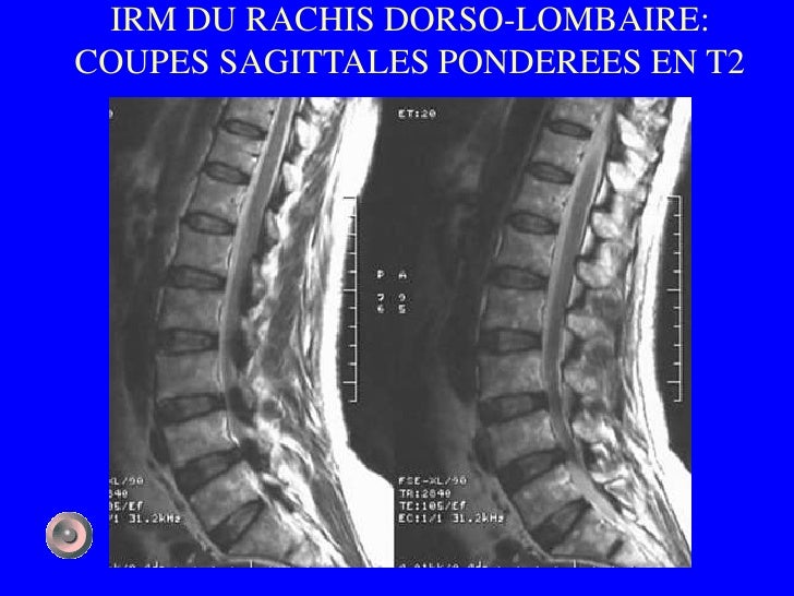 Irm rachis dorso lombaire - Michelle Leatham