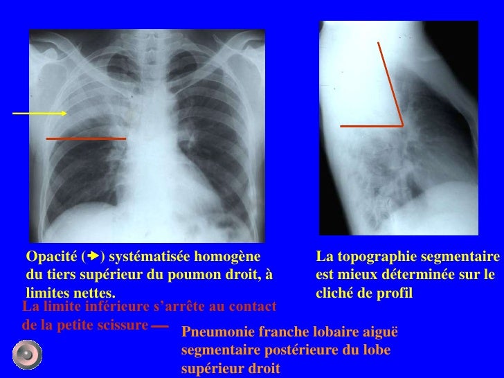 Opacité Parenchymateuse Lobaire – FBUGM