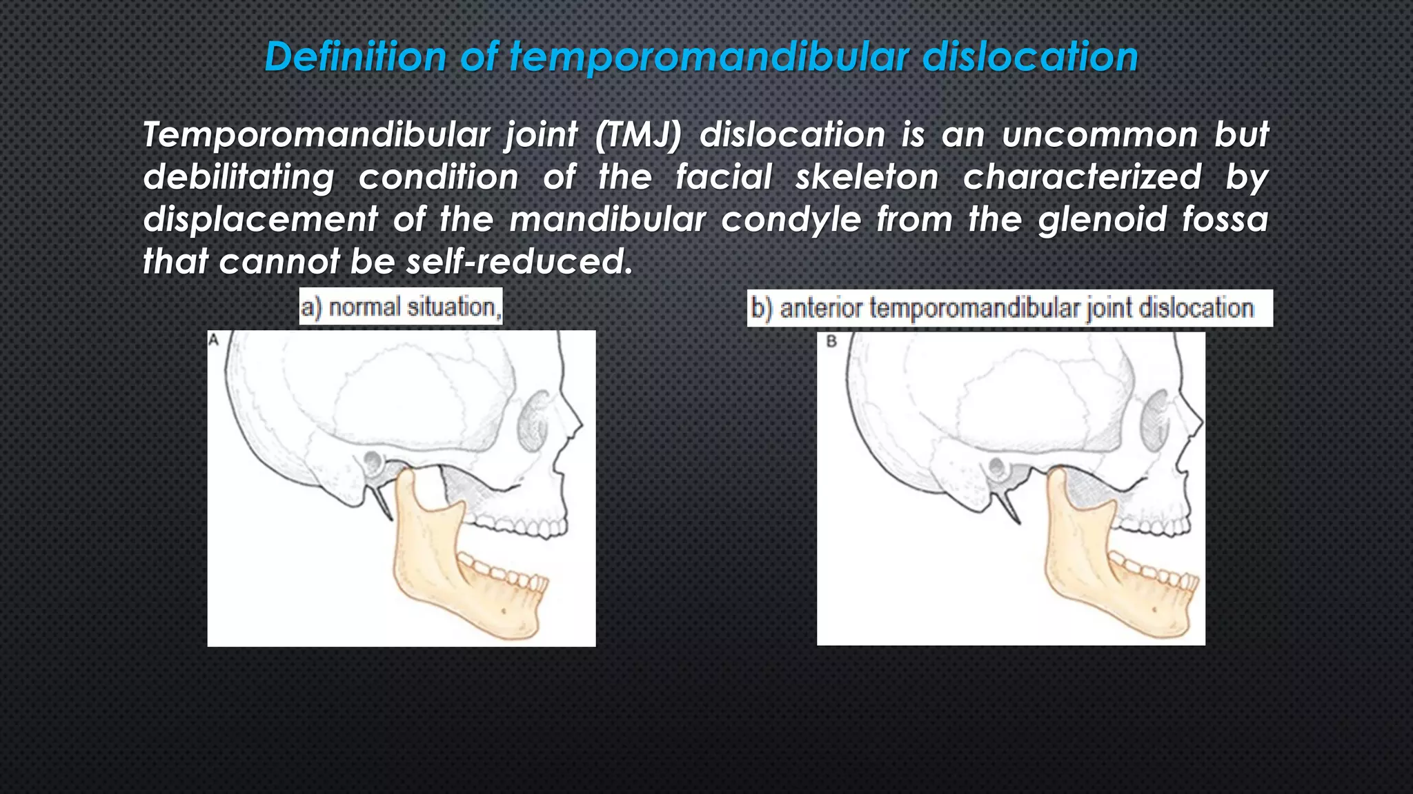 Acute Dislocation temporomandibular joint | PDF