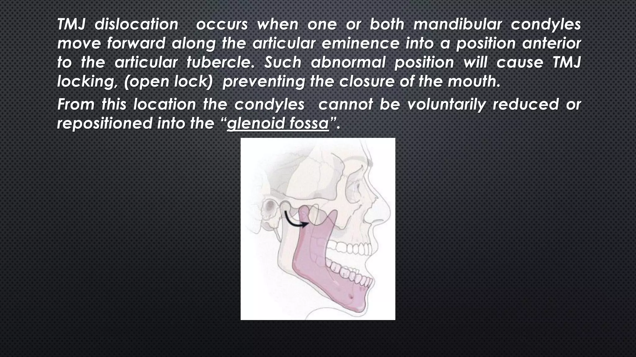 Acute Dislocation temporomandibular joint | PDF