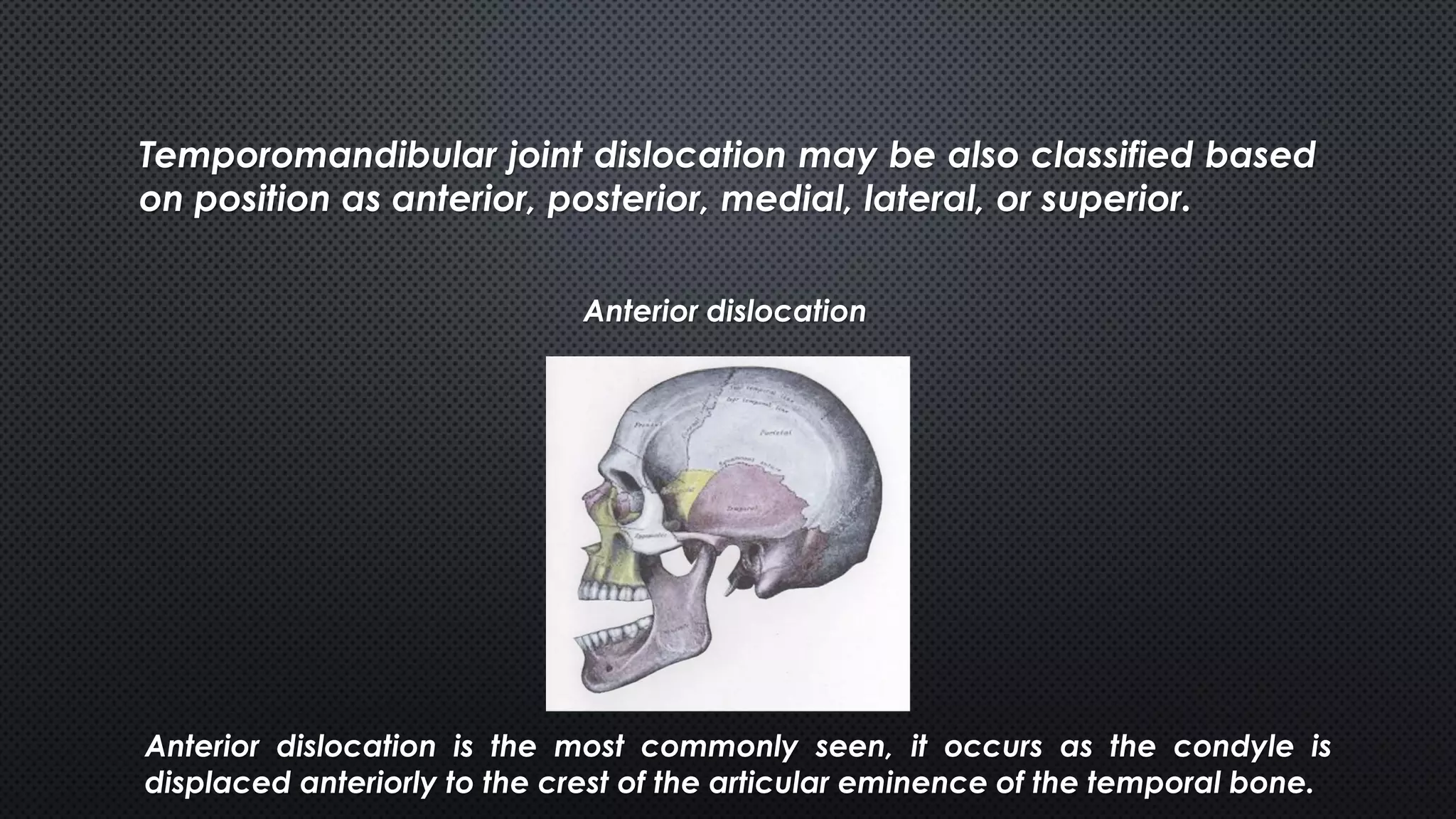 Acute Dislocation temporomandibular joint | PDF