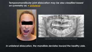 Acute Dislocation temporomandibular joint | PDF