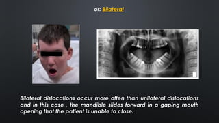 Acute Dislocation temporomandibular joint | PDF
