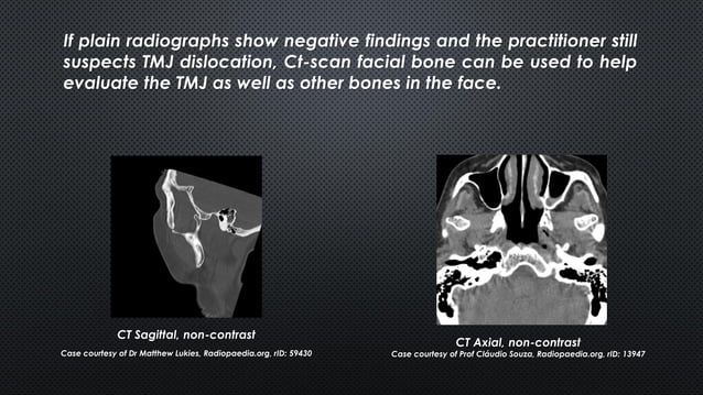 Acute Dislocation temporomandibular joint | PPT