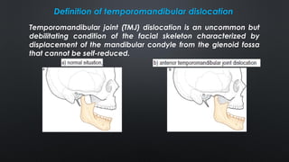 Acute Dislocation temporomandibular joint | PDF