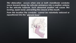 Acute Dislocation temporomandibular joint | PDF