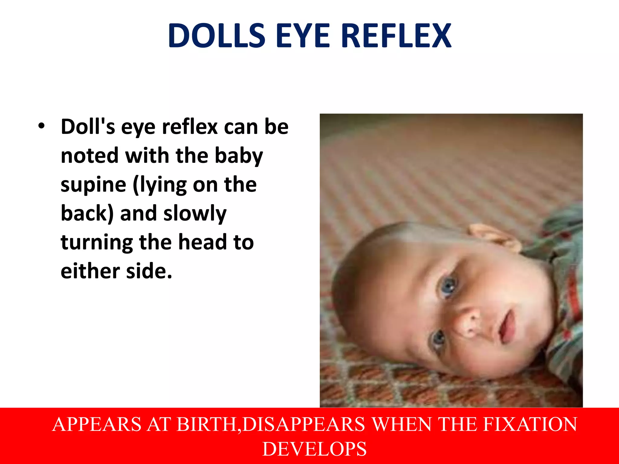 ASSESSMENT OF NEWBORN REFLEXES | PPTX