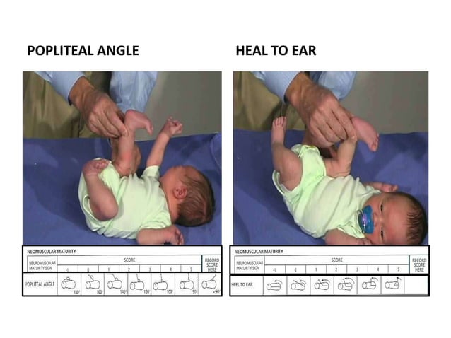 ASSESSMENT OF NEWBORN REFLEXES | PPTX