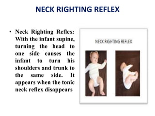 Optical Righting Reflex Infants