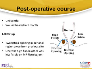 Crohn's Disease | PPTX