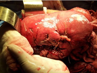 1 B.A - Liver Injury - Case presentation.pptx