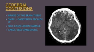 BRAIN INJURIES IN CT | PPTX