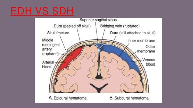 BRAIN INJURIES IN CT