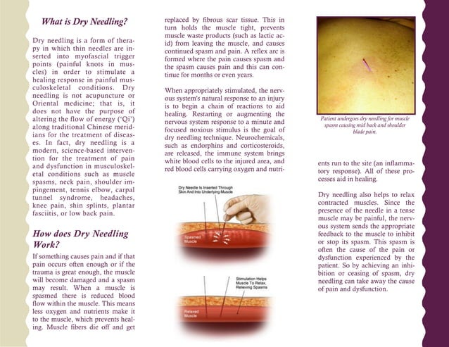 Dry Needling Brochure All Locations | PDF