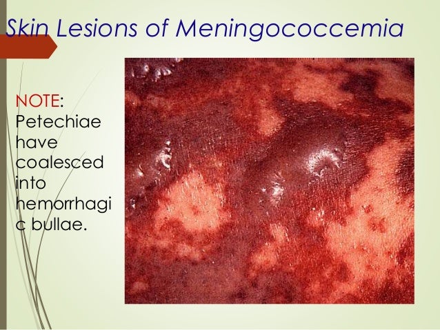 Bacterial meningitis