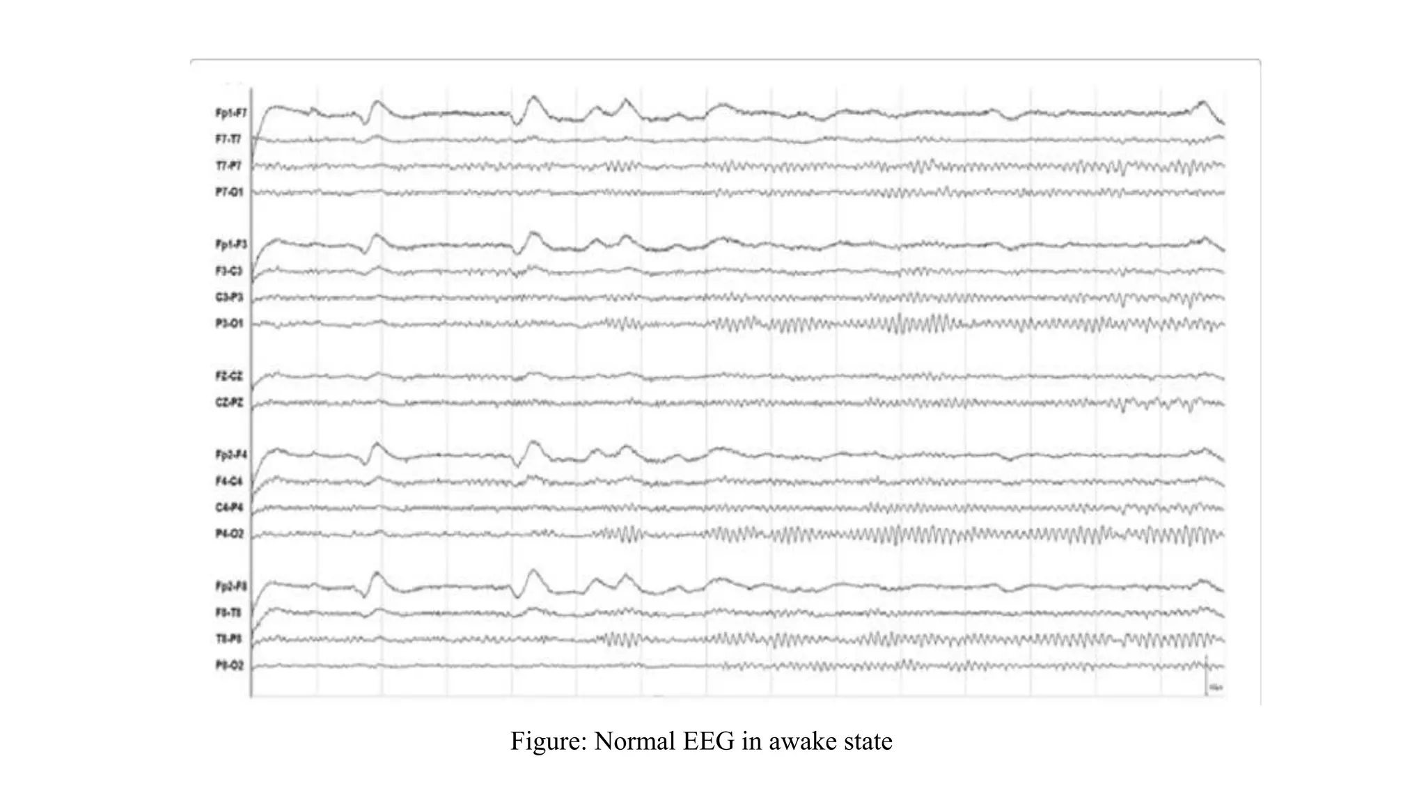 1 basics of eeg and fundamentals of its measurement | PPTX
