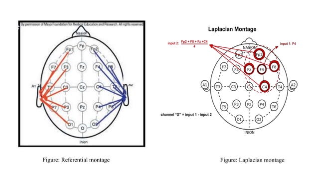 1 basics of eeg and fundamentals of its measurement | PPT