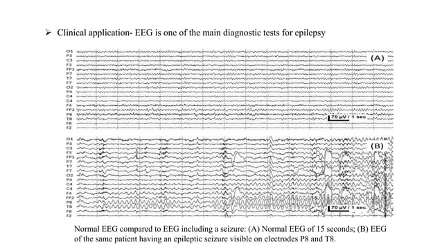 1 basics of eeg and fundamentals of its measurement | PPT