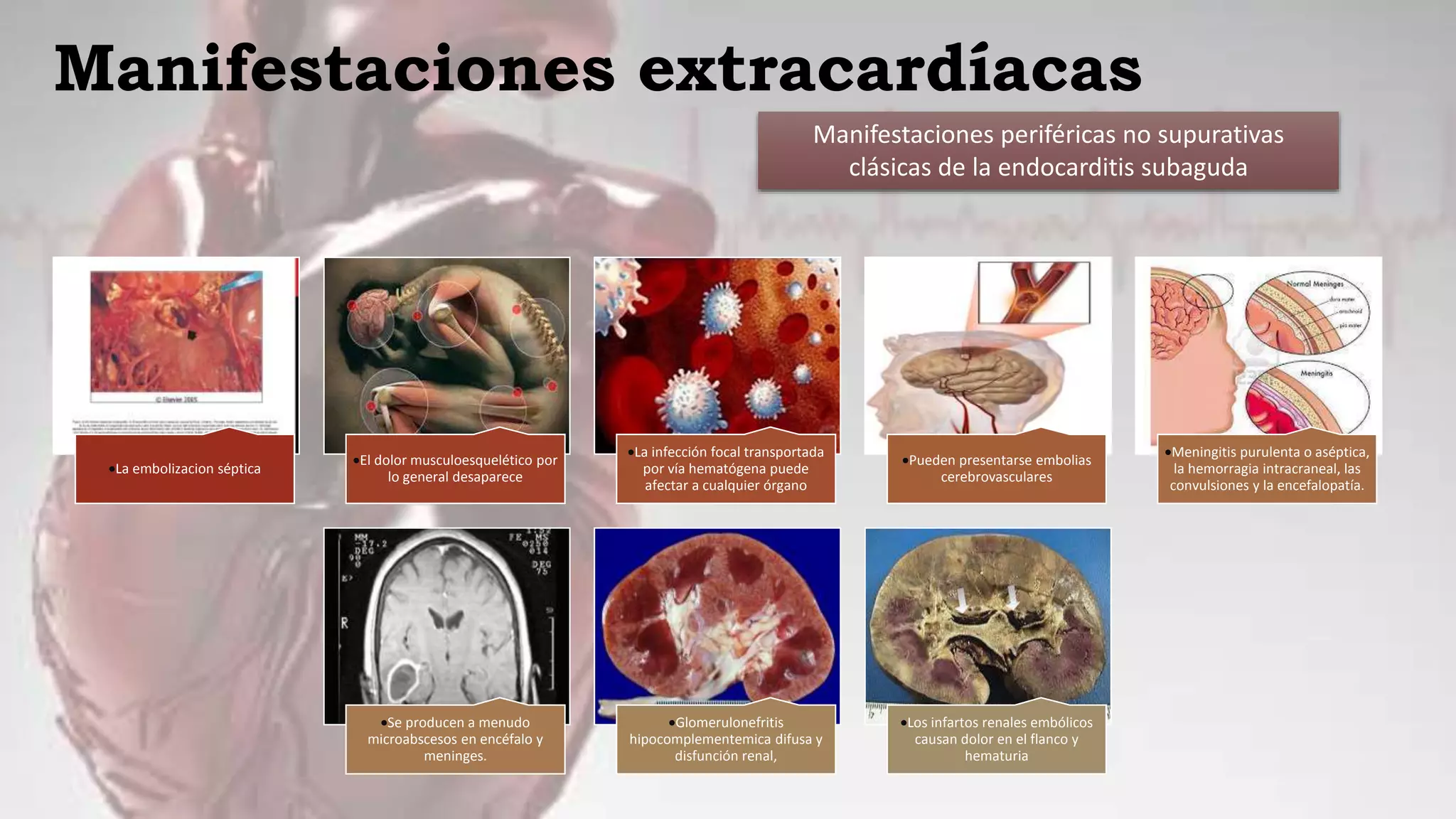 Endocarditis infecciosa: Diagnostico y clinica | PPTX
