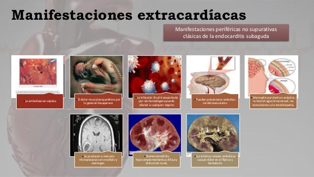 Endocarditis infecciosa: Diagnostico y clinica