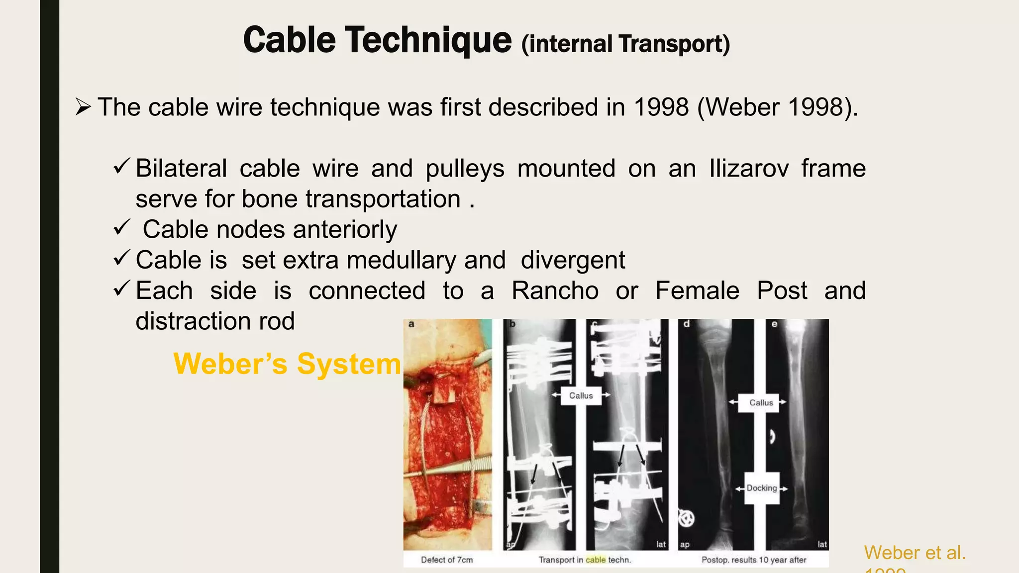 Cable techniques for bone transport in massive bone defects #dr_azanki ...