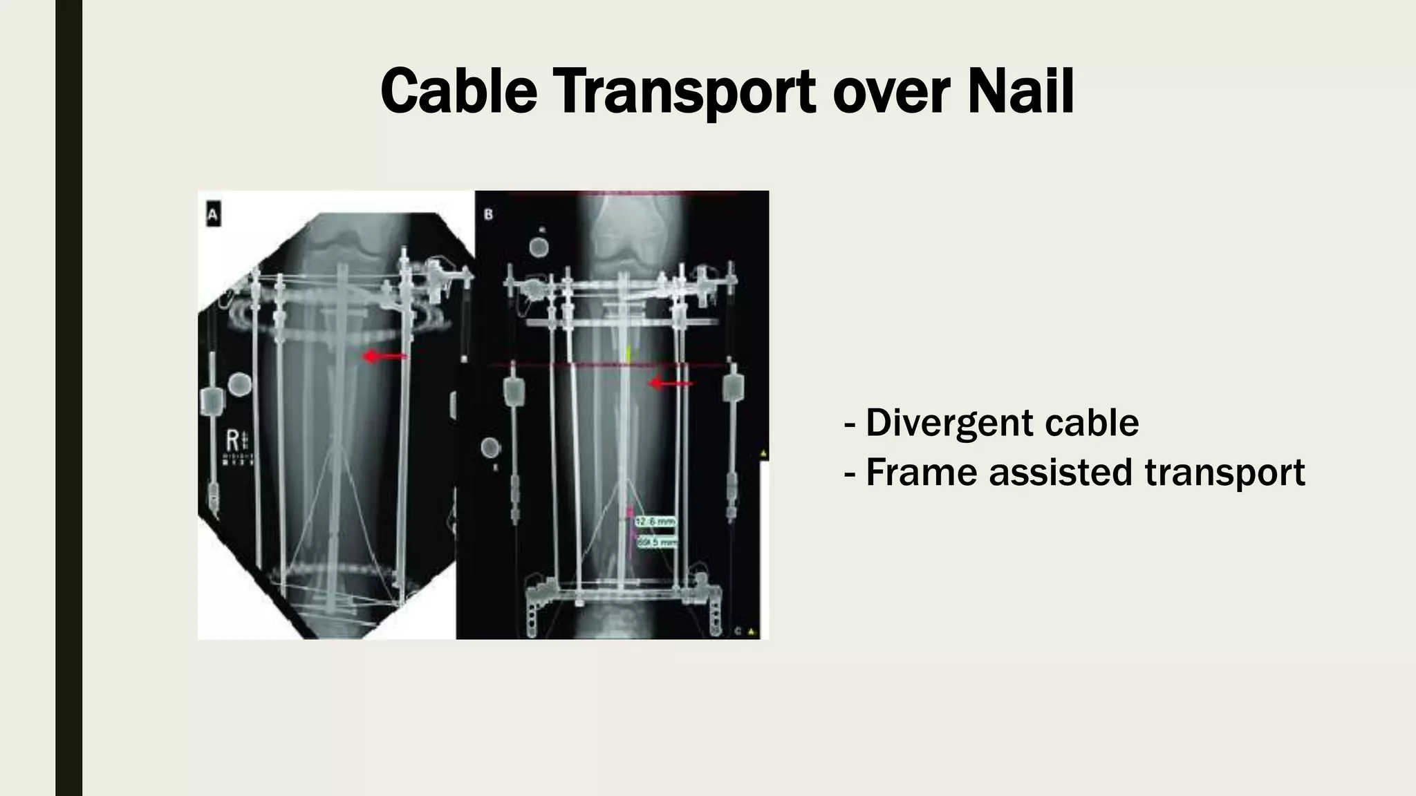 Cable techniques for bone transport in massive bone defects #dr_azanki | PPTX