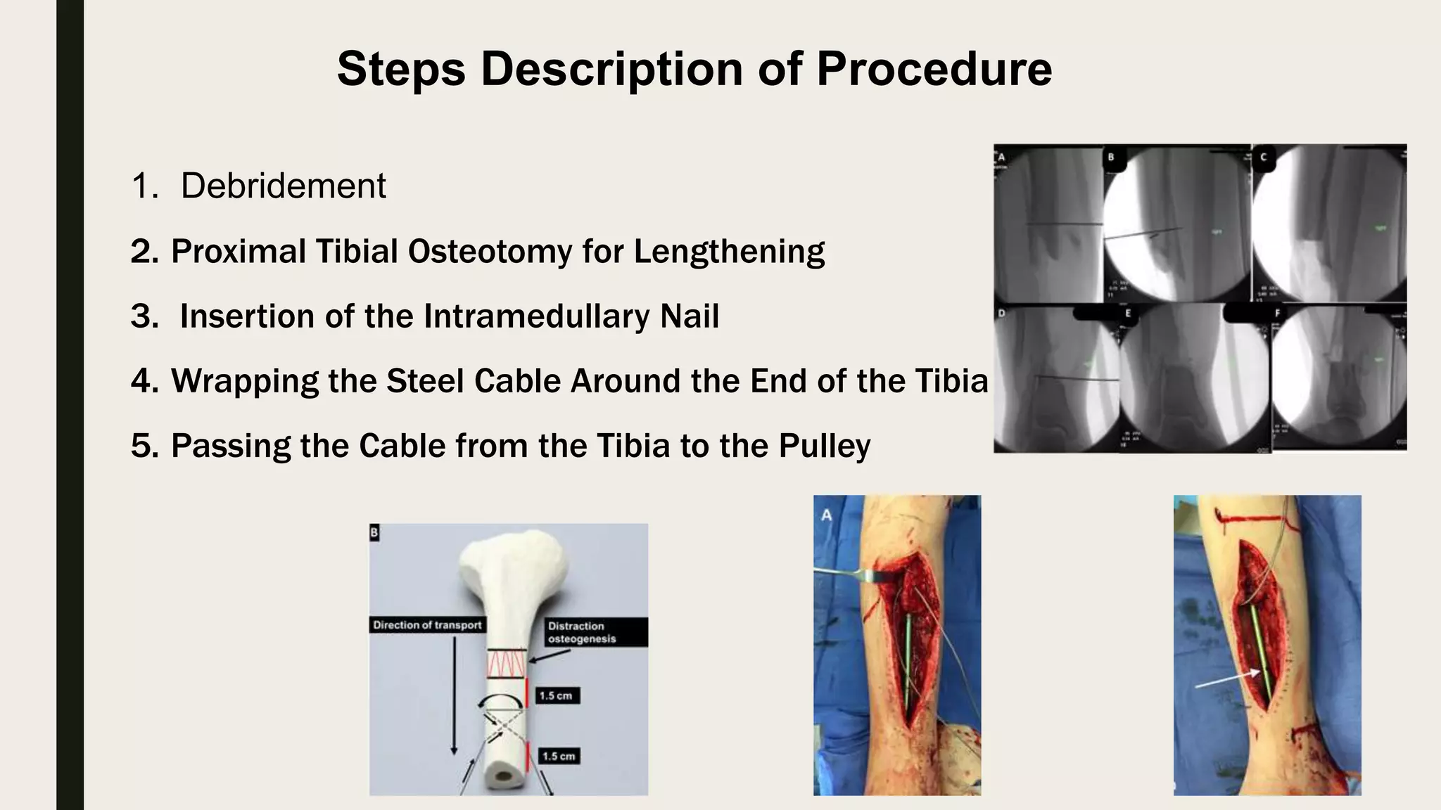 Cable techniques for bone transport in massive bone defects #dr_azanki ...