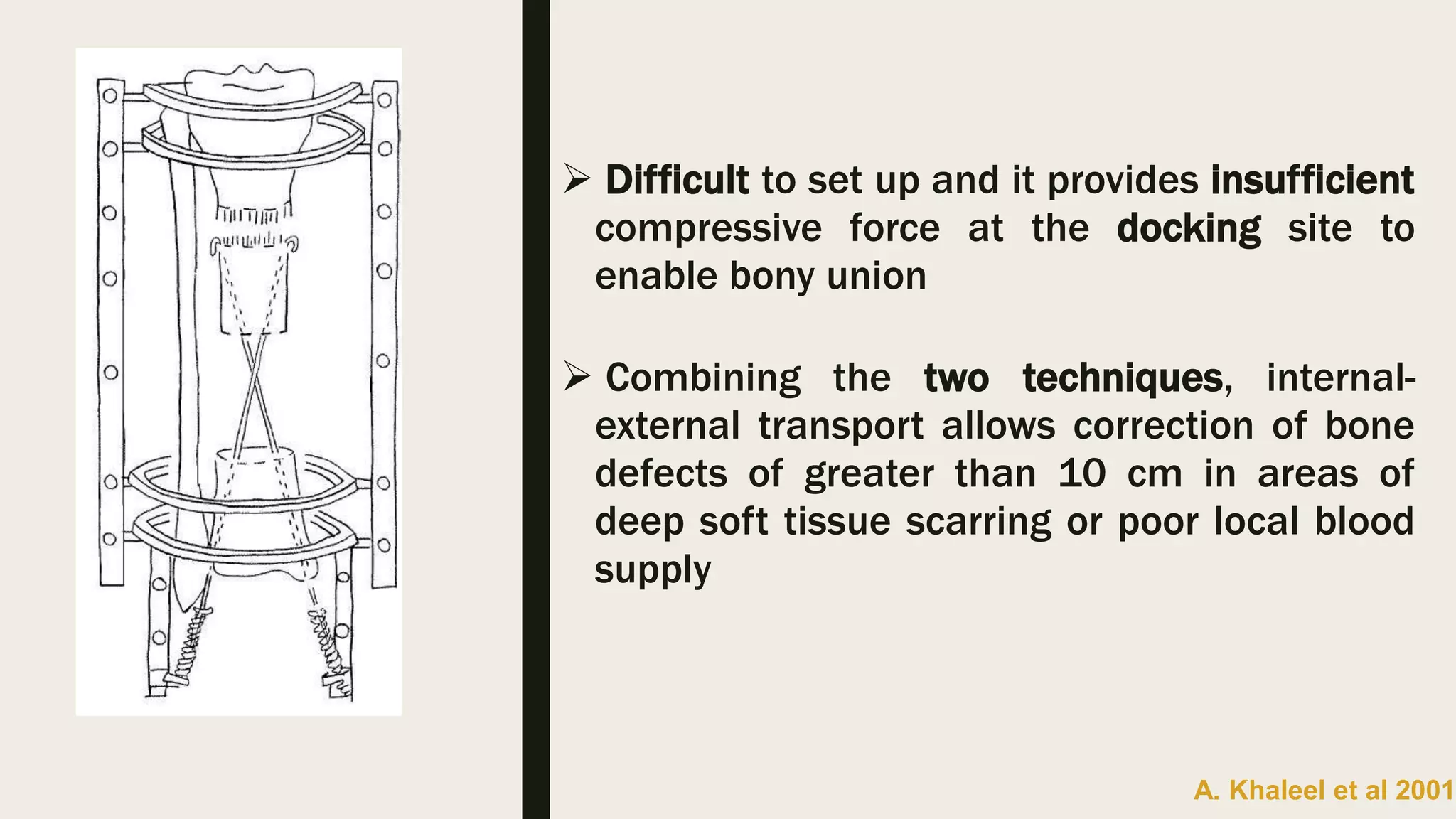Cable techniques for bone transport in massive bone defects #dr_azanki ...