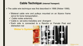 Cable techniques for bone transport in massive bone defects #dr_azanki ...