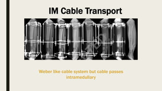 Cable techniques for bone transport in massive bone defects #dr_azanki ...