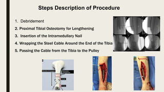 Cable techniques for bone transport in massive bone defects #dr_azanki ...