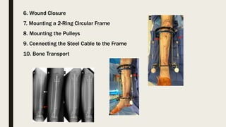 Cable techniques for bone transport in massive bone defects #dr_azanki ...