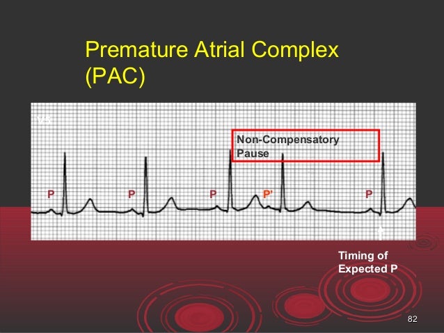 cardiac arrhythmias