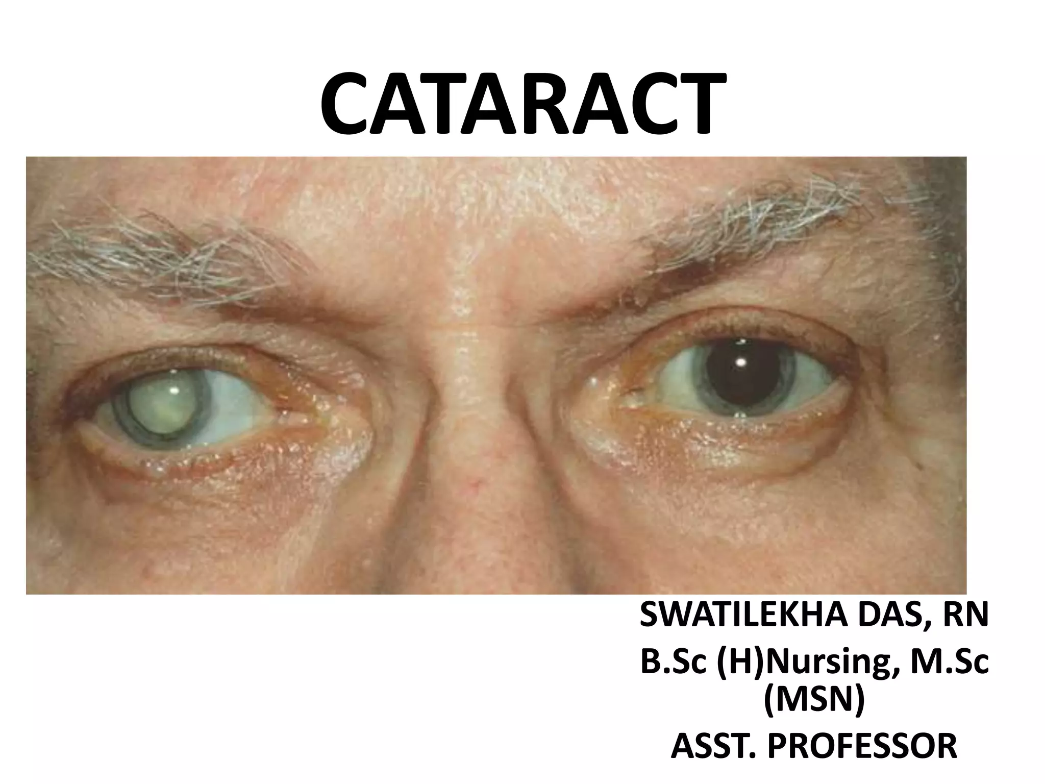Cataract - Easy PPT for Nursing Students | PDF