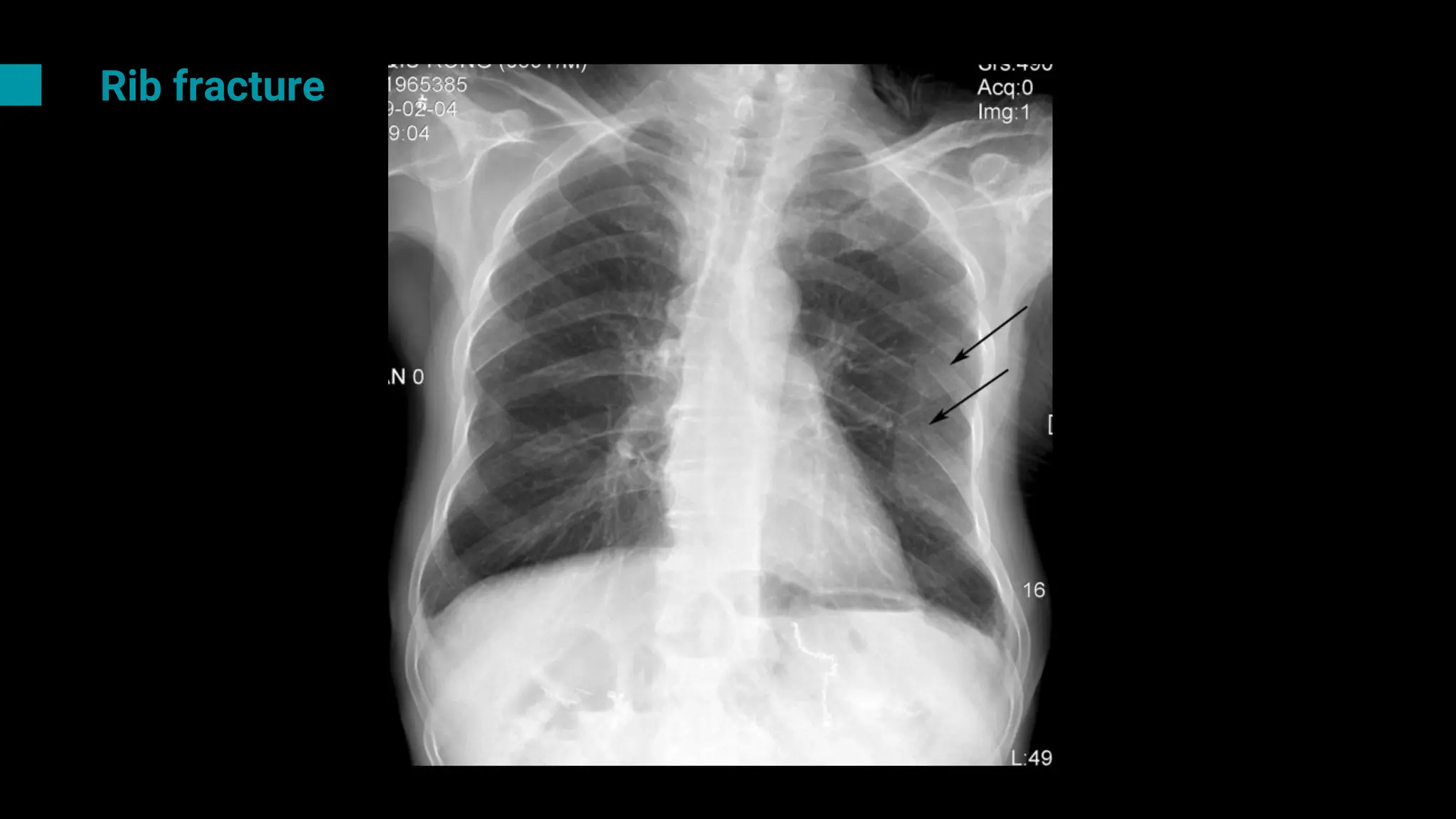 A discription of chest wall trauma in a clinical setting | PPT