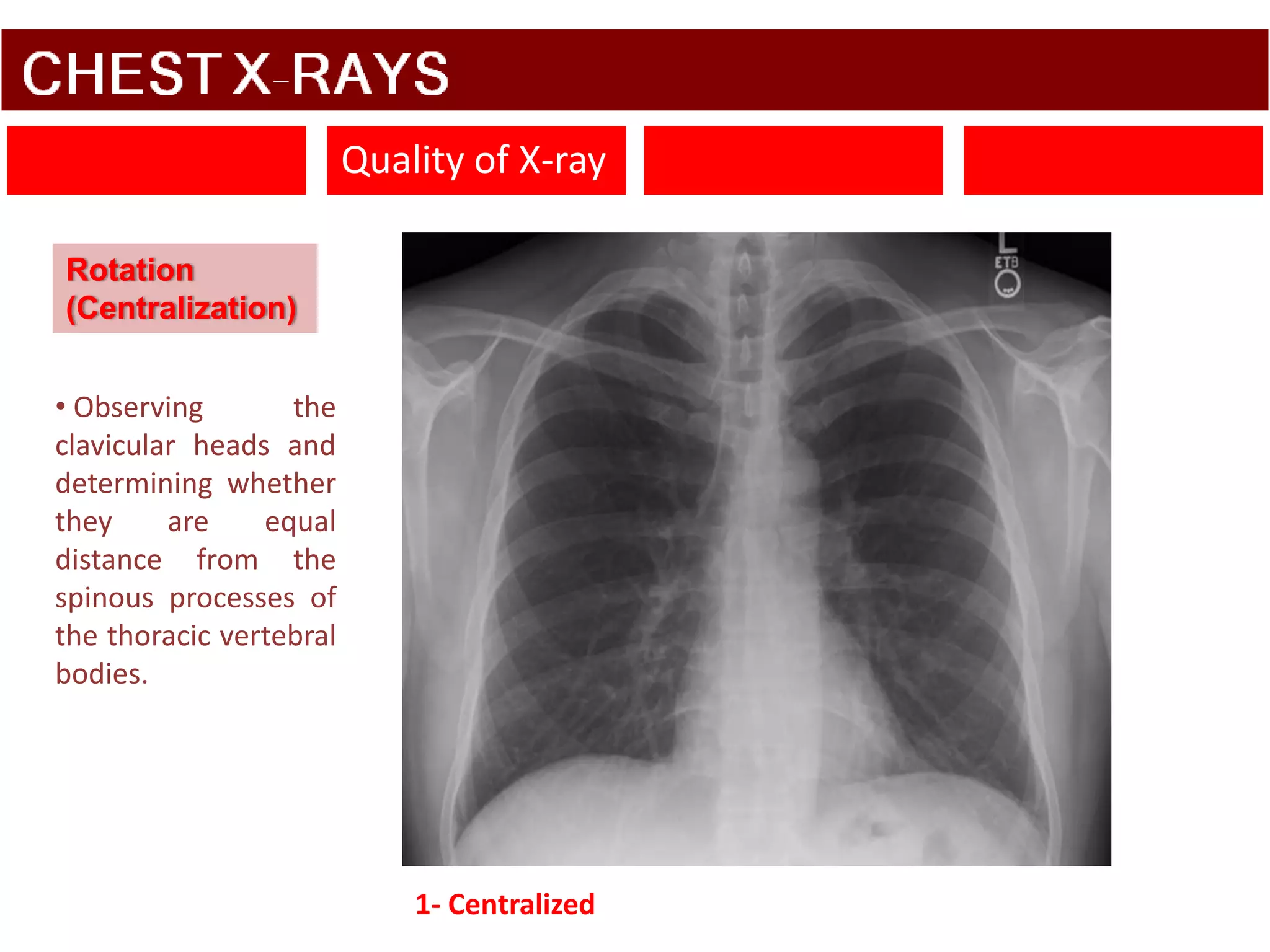 1 Chest X rays.pptx